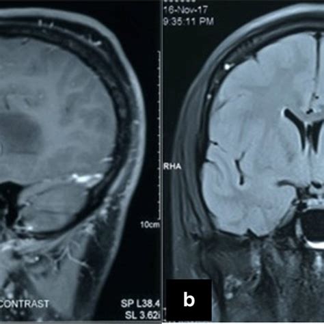 Primary Intracranial Ewing Sarcoma Peripheral Primitive Neuroectodermal Tumor An Entity Of