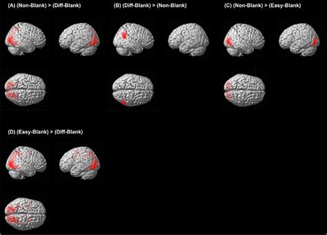 Areas Were More Activated In Blank Phase Voxel Level Threshold Of