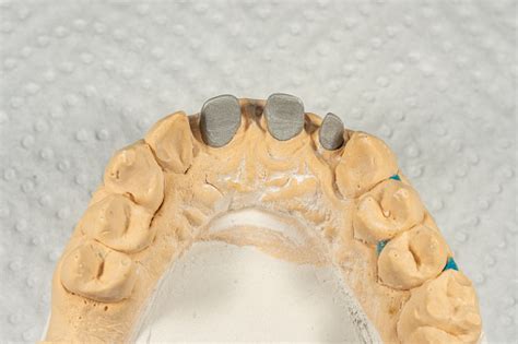 치과 실험실에서 석고 모델 클로즈업에 인간의 치아의 금속 캐스트 핀 크라운 복원을위한 정형 외과 치과 준비 개념에 대한 스톡