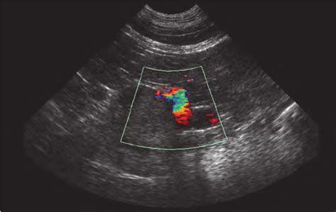 Aliasing The velocity overwhelms the máximum limit in the velocity Download Scientific Diagram