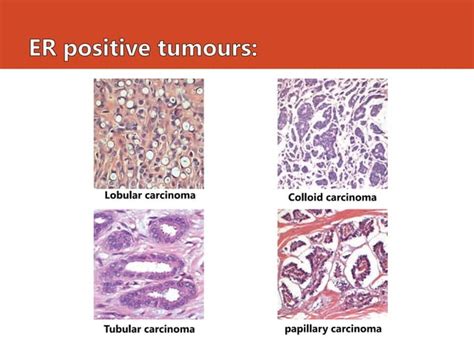 Classification Breast Tumour Pptx