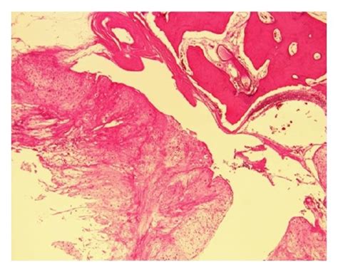 A Atypical Chondrocytic Cells In Myxoid Or Chondroid Matrix Showing