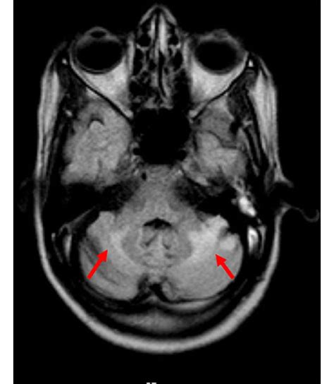 T2 Flair Image Showing Hyperintensity Involving Bilateral L R Download Scientific Diagram