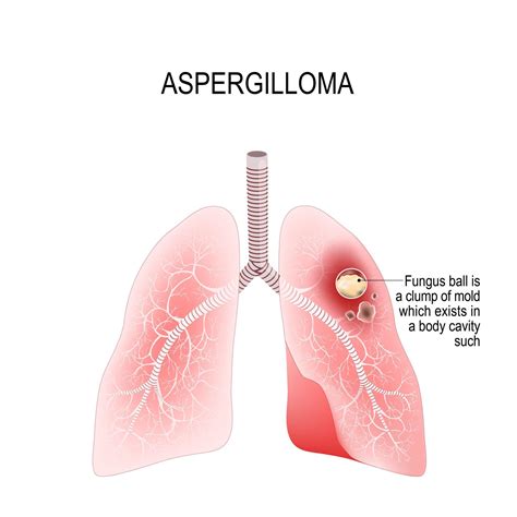 Aspergilloma Fungus Ball In Lungs Causes Symptoms