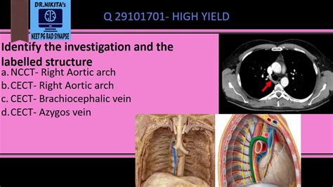 Identifying Azygos Vein On Ct Youtube