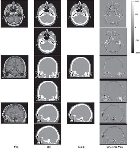 Figure 5 From Mr‐based Synthetic Ct Generation Using A Deep Convolutional Neural Network Method