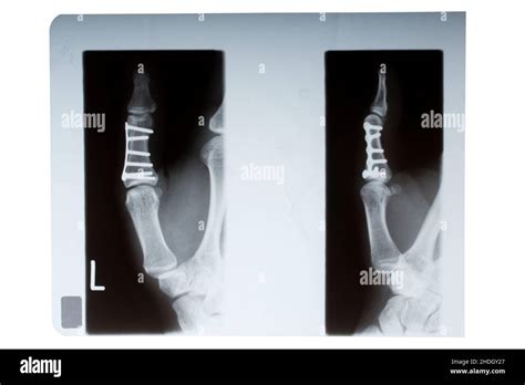 Pouce Humain Image Radiologique Fracture Pouces Humains Pouce