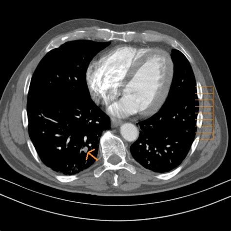 Subsegmental Acute Pulmonary Embolism With Right Ventricular Overload Eurorad
