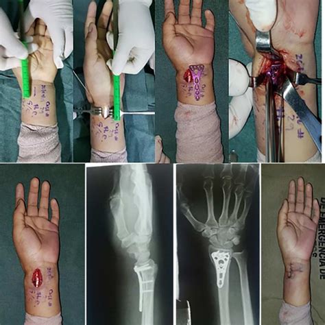 Longitudinal I Shape Incision A Measurement Of The Incision B The