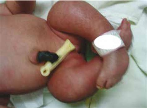 Figure 1 From Caudal Regression Syndrome A Case Report Semantic Scholar