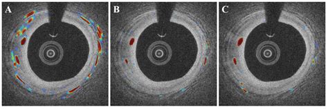 Bioengineering Free Full Text Automated Segmentation Of Microvessels In Intravascular Oct