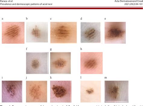 Figure 1 From Prevalence And Dermoscopic Patterns Of Acral Melanocytic Nevi In Turkey Figure 1 From Prevalence And Dermoscopic Patterns Of Acral Melanocytic Nevi In Turkey