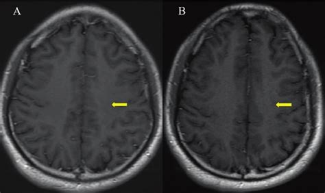 Post Contrast MRI 1 Month A And 3 Months B After Discharge Axial Download Scientific