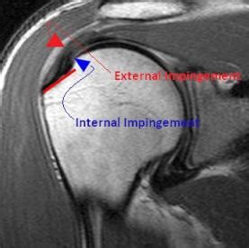 Internal Impingement Shoulder And Elbow Orthobullets