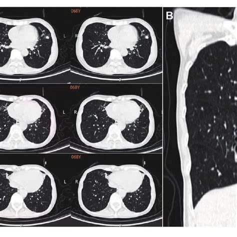 Chest Ct Imaging A Chest Ct Scan Showed Scattered Patchy Opacities Download Scientific