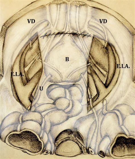 Extended Pelvic Lymph Node Dissection Oargv