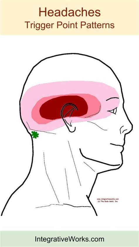 tags headache trigger points headache remedies headache