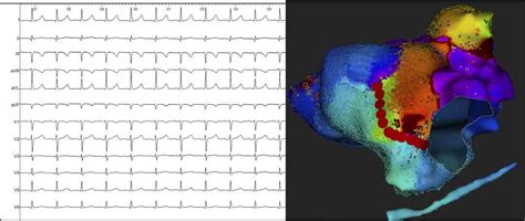 Ablación De Flúter Auricular Atípico En Paciente Portadora De Prótesis Mitral Guiada Mediante