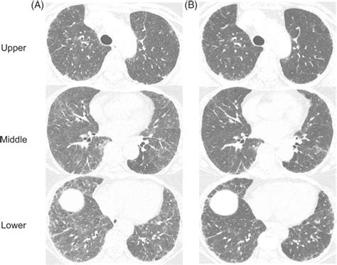 Findings From Chest Radiograph And Ct On Admission A And After Download Scientific Diagram