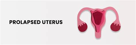 Prolapsed Uterus Symptoms Causes And Treatment Options