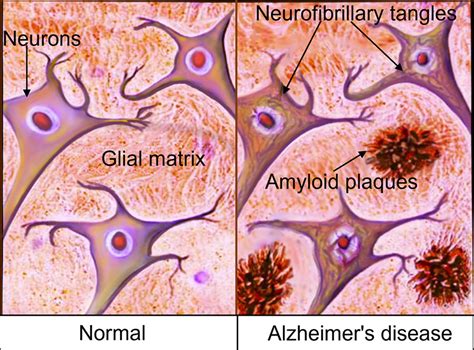 Amyloid Related Imaging Abnormalities In Alzheimer Disease Treated With