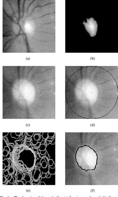 Figure 10 From A Contribution Of Image Processing To The Diagnosis Of Diabetic Retinopathy
