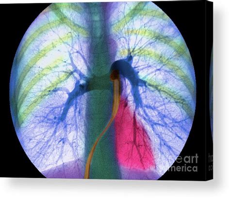 Coloured Angiogram Showing The Pulmonary Arteries Acrylic Print By