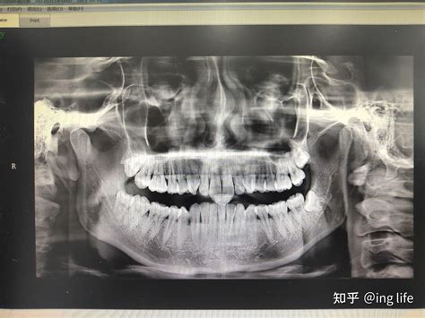 拔智齿的第一天，一次两颗 知乎