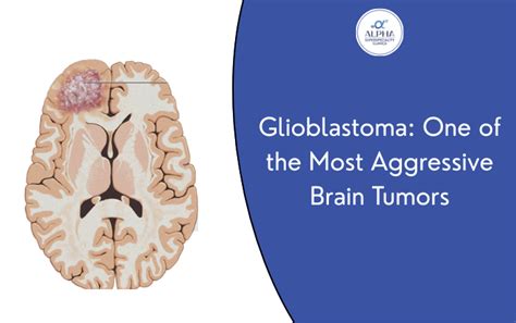 Understanding Glioblastoma One Of The Most Aggressive Brain Tumors