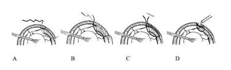 Is There A Need For Arthroscopic Subacromial Decompression In Treating