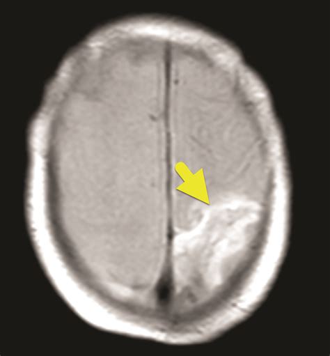 Parietal Lobe Infarction Secondary To Cortical Venous Thrombosis Applied Radiology