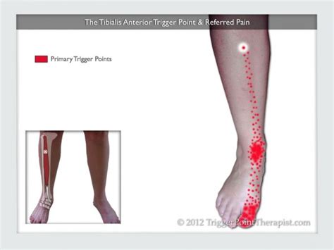 Tibilais Anterior Trigger Point The Foot Drop Trigger Point TriggerPointTherapist Com