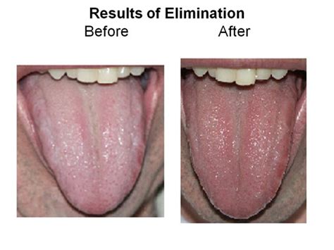Tongue Assessment Victor Zeines Dds Ms New York New York