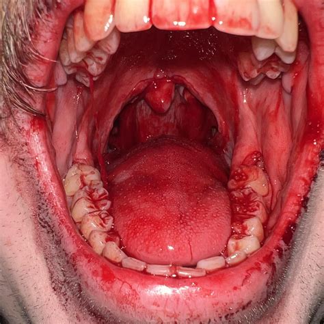 Aftermath Of My Tonsillectomy Not Healing Properly Rmakemesuffer