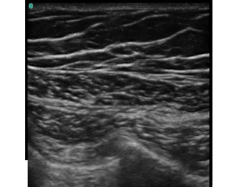 Pectoralis Block Quiz