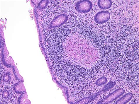 Pathology Outlines Granulomatous Appendicitis