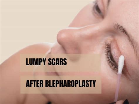 Upper Blepharoplasty Scars Blepharoplasty San Diego Dr Kolstad