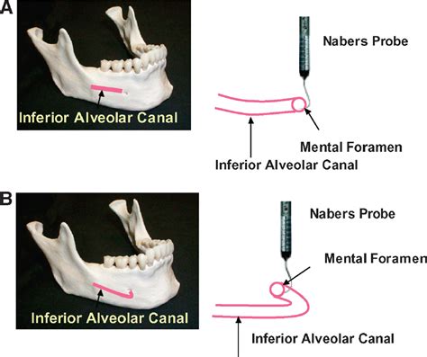 Mental Nerve Distribution