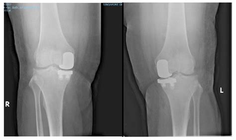 Bilateral Unicompartmental Partial Knee Replacement Uka