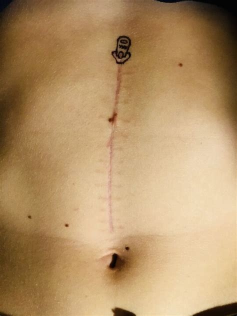 Rare Disease Day Vascular Compression Syndrome