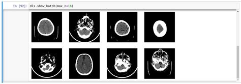 Medical Imaging In Fastai V2 Fastai Fast Ai Course Forums