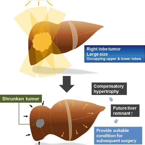 Clinical Implication Of Compensatory Hypertrophy After External Beam