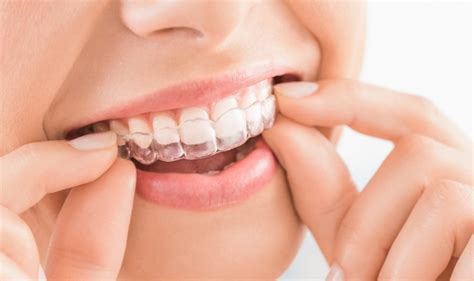 Teeth Alignment Vs Straightening Key Differences Explained