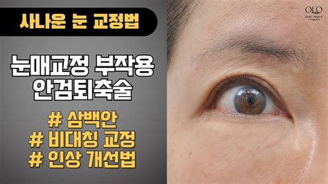 재수술 고민이시죠 중년 눈 재수술 사나운 눈 눈매교정부작용 삼백안 비대칭교정 중년눈성형 눈재수술 짝눈 삼백안 비대칭개선 Youtube