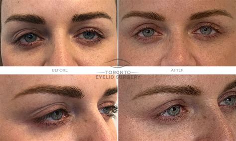 Lateral Canthopexy Before After