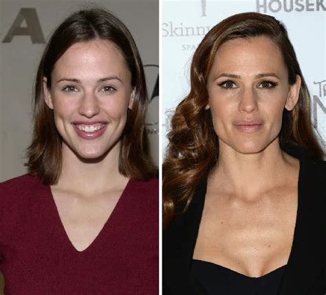 Jennifer Garner Before And After Plastic Surgery