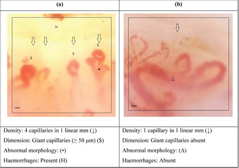 Nailfold Capillaroscopy By Digital Microscope In A Guatemalan Population With Systemic Sclerosis