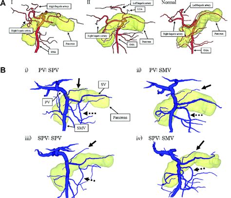 Accessory Hepatic Artery