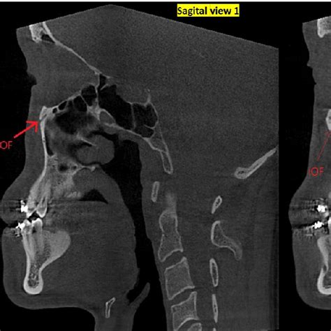 Cone Beam Computed Tomography In The Planes Showed Infraorbital Foramen Download Scientific