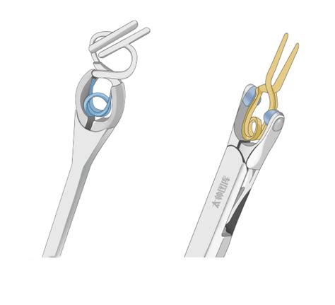 颅内动脉瘤 医学插画